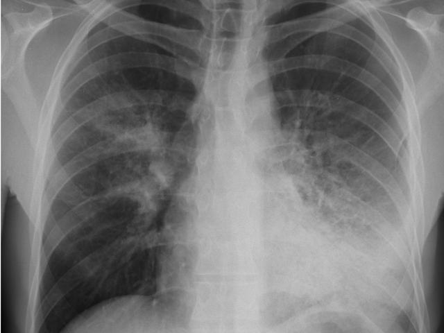 Pleurésie; pleurisies; pleuritides; pleuritis